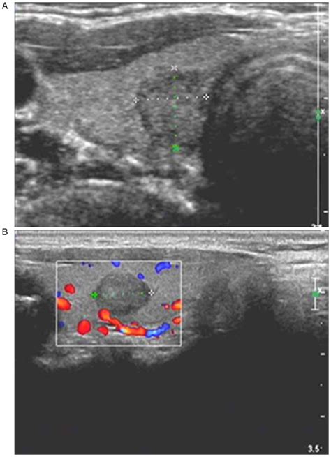 Clinical Value Of Color Doppler Ultrasound Combined With Serum Tumor