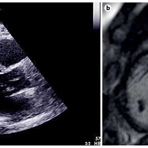 Transthoracic Echocardiogram Parasternal Long Axis View Showing Mild