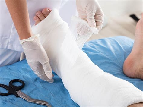 Application Of Plaster Of Paris ED Areyouprepared