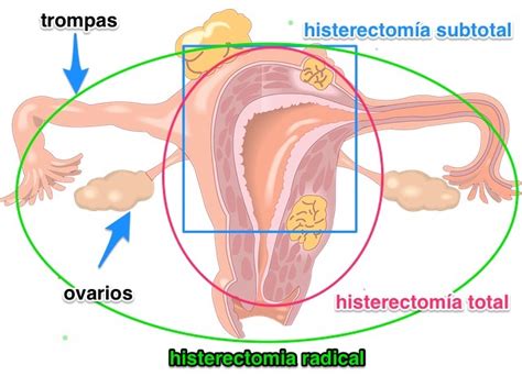 Histerectomía Cuántos tipos existen ConsultaTuGinecologo