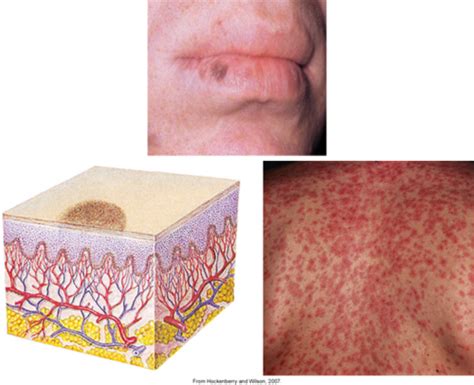 Primary Secondary Vascular Purpuric Skin Lesions Id Info