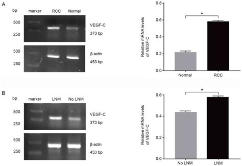 Expression Levels Of VEGFC And VEGFR3 In Renal Cell Carcinoma And
