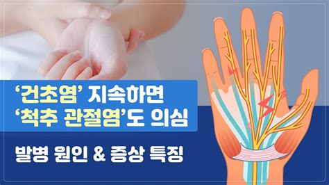힐팁 TV 건초염 지속하면 척추 관절염도 의심발병 원인 증상 특징 YouTube