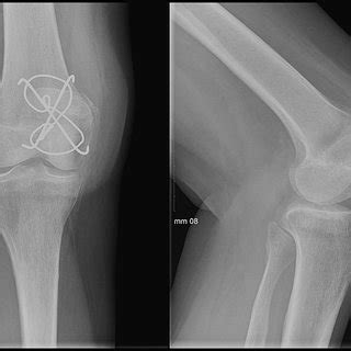 Preoperative A And Postoperative B Anteroposterior And Lateral