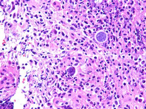 June 09 Coccidioides Precision Pathology