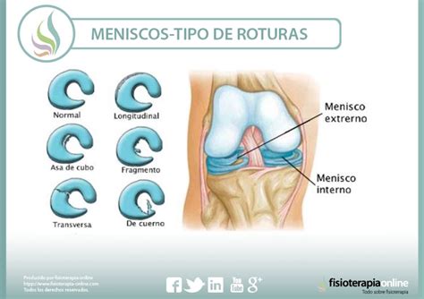 Rotura de menisco Qué es causas síntomas tratamiento y consejos