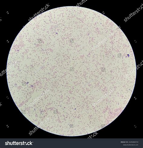 Gardnerella Vaginalis Genital Infection Bacterial Vaginosis Stock Photo