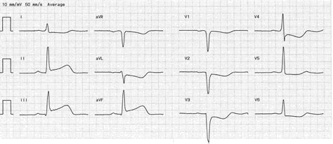 Myokardinfarkt Fokus EKG