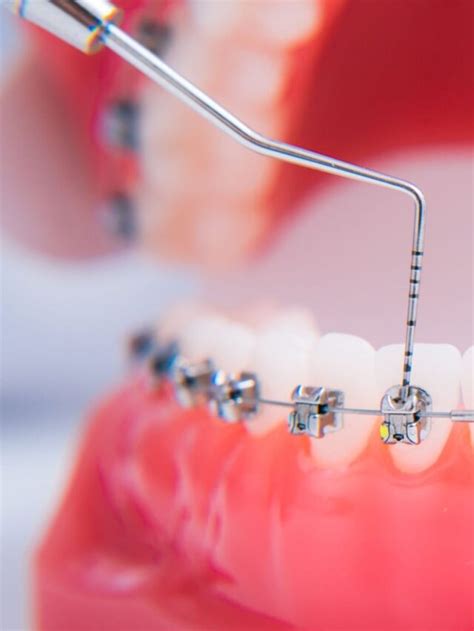 Conheça os 4 tipos principais de aparelho ortodôntico Blog OralDents