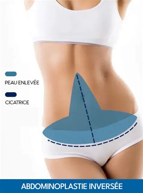 Abdominoplastie Tunisie Chirurgie Ventre Plat Tunisie Prix