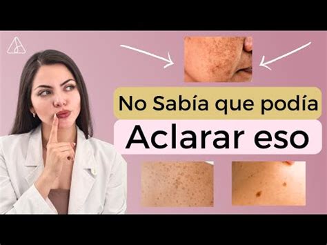 Descubre cómo eliminar pecas y lunares de forma efectiva Los mejores