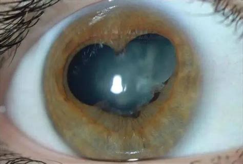 Overworked Chinese Mans Pupil Turns Heart Shaped And Becomes Inflamed The Epoch Times