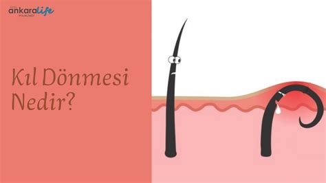KIL DÖNMESİ NEDİR TEKRAR OLMAMASI İÇİN NE YAPILIR