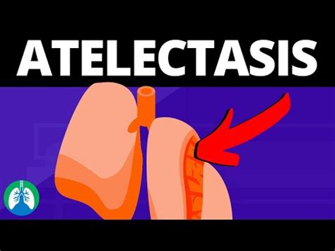 Atelectasis Medical Definition Quick Explainer Video YouTube
