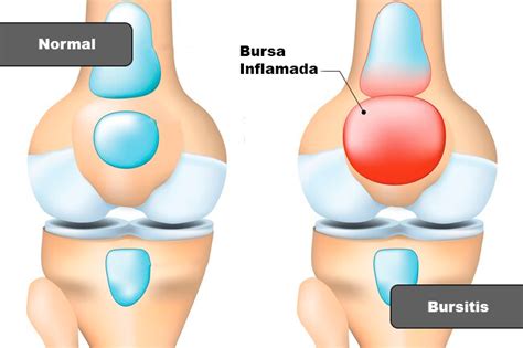 Fisioterapia Heredia Qué son las bursas Afectación Principal bursitis