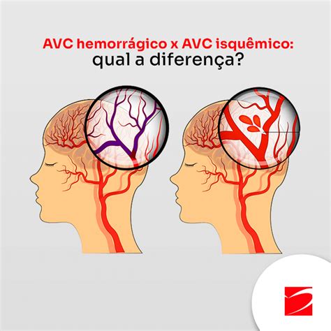 Entenda O Avc Icor Instituto Do Cora O De Santa Maria