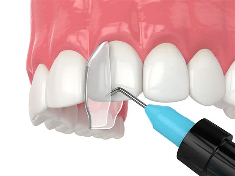 Types Of Teeth Shapes And How To Change Them