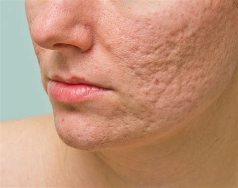 Cicatrizes De Acne Dermapro Clinic