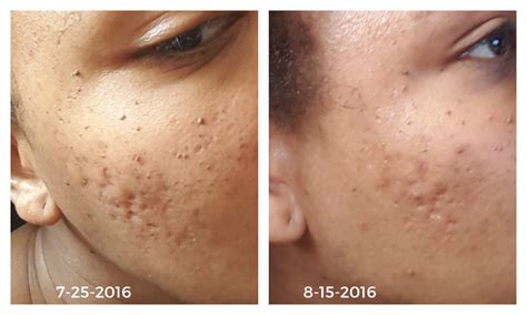 How To Get Rid Of Pitted Acne Scars