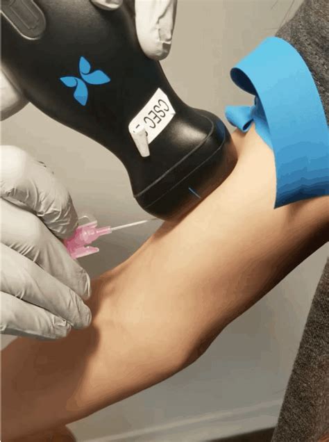 Ultrasound Guided Peripheral IV Insertion Placement And Access Made