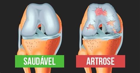 3 Remédios caseiros para Artrose Tua Saúde