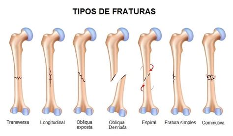 Tipos De Fraturas Anatomia I