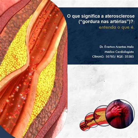 ATEROSCLEROSE GORDURA NAS ARTÉRIAS PIUMHI HOSPITAL DIA
