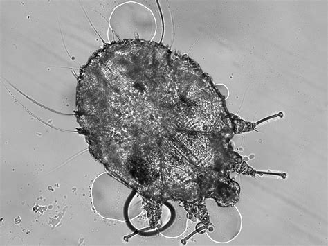 Scabies Pimples