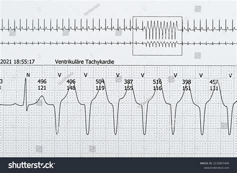 Nonsustained Ventricular Tachycardia On Electrocardiogram Stock Photo