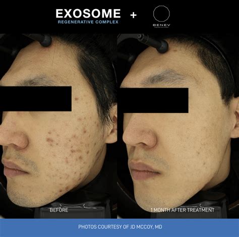 Exosomes Archon Aesthetics