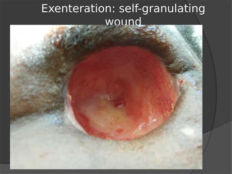 Conjunctival Squamous Cell Carcinoma Ppt