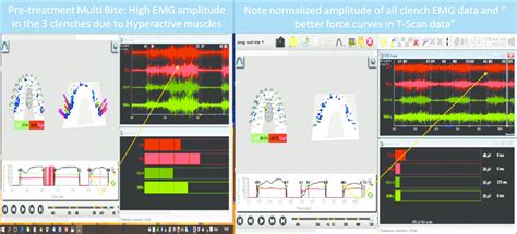 Pre Treatment Multi Bite High Electromyography EMG Amplitude In The