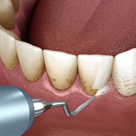 Full Mouth Reconstruction Albuquerque NM New Mexico Smile Center