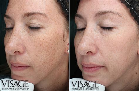 HALO Laser Skin Resurfacing Atlanta GA Dr Burke Robinson