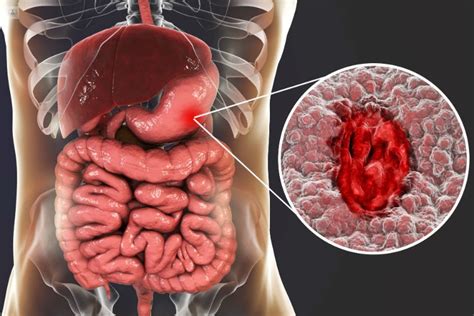 Lcera G Strica Qu Es S Ntomas Y Tratamiento Top Doctors