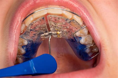 What A Palatal Expander Is How They Work Greater Vancouver Orthodontist