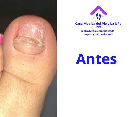 Reconstrucción de Uñas Casa Medica del Pie y La Uña