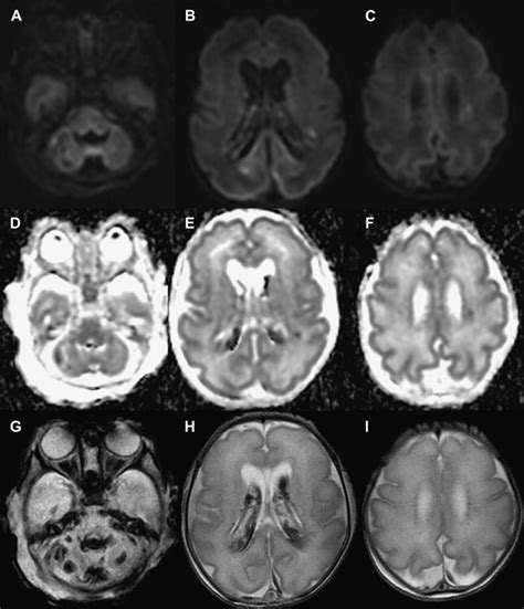 Diffusion Weighted Imaging In Neonates Radiology Key