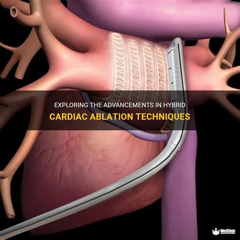 Exploring The Advancements In Hybrid Cardiac Ablation Techniques Medshun