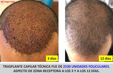 Dermatología Madrid CUÁNTO CUESTA UN INJERTO CAPILAR