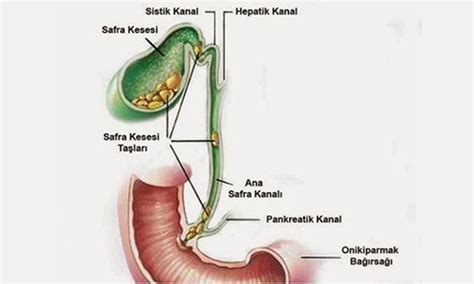 Kolelitiazis Safra Kesesi Taşı Op Dr Ahmet Önal