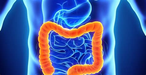 Wrzodziejące zapalenie jelita grubego Colitis Ulcerosa objawy leczenie