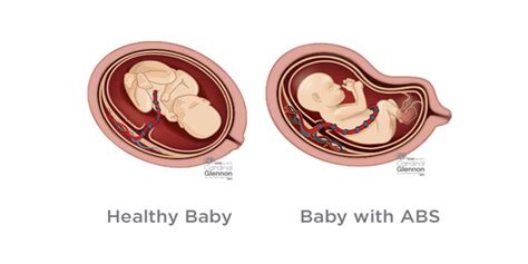 Amnion Ultrasound