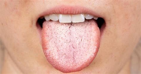Por qué tengo la lengua blanca Interoralia