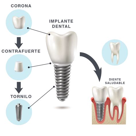Implantes dentales en Panamá Dental One