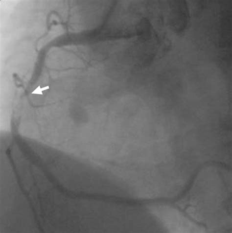 Acute Coronary Syndrome Unstable Angina And Non ST Segment Elevation