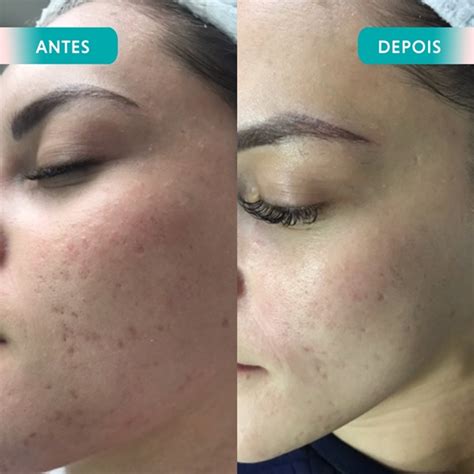 Microagulhamento Antes E Depois