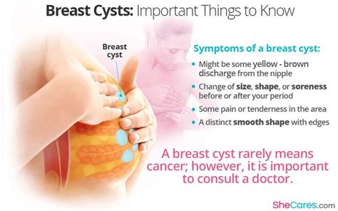 Understanding Breast Cysts Common And Harmless Condition
