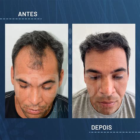 Cl Nica Mansur Transplante Capilar