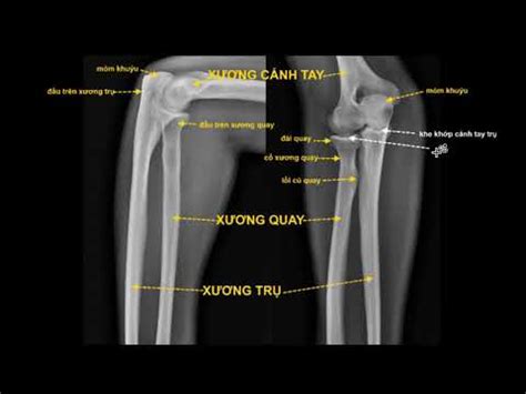 Những điều thú vị về hình ảnh giải phẫu xương cánh tay